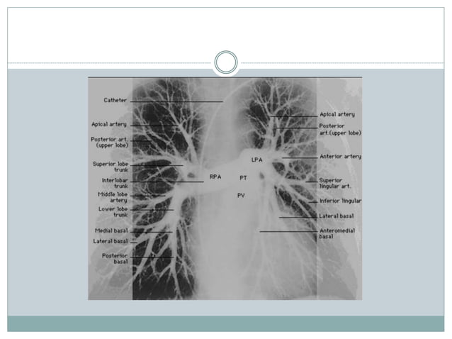 Pulmonary embolism radiology