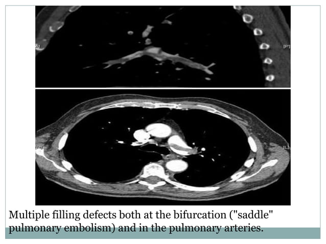 Pulmonary embolism radiology
