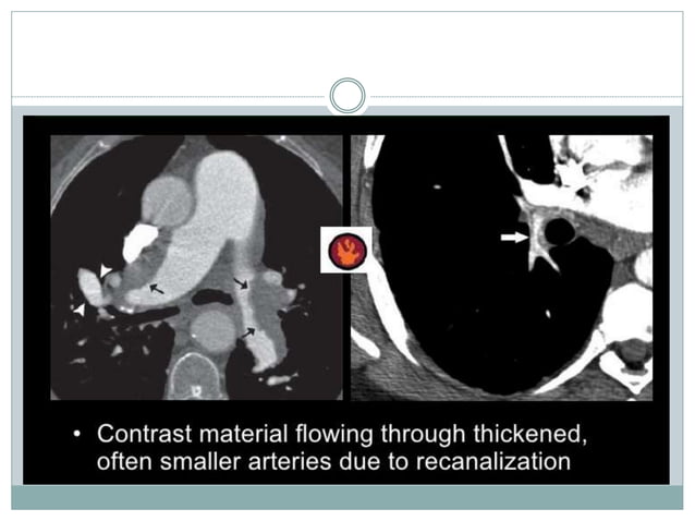 Pulmonary embolism radiology