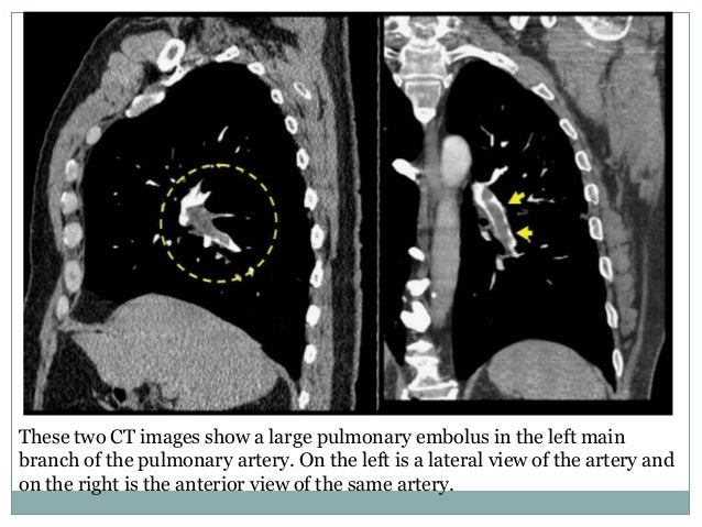 Pulmonary embolism radiology