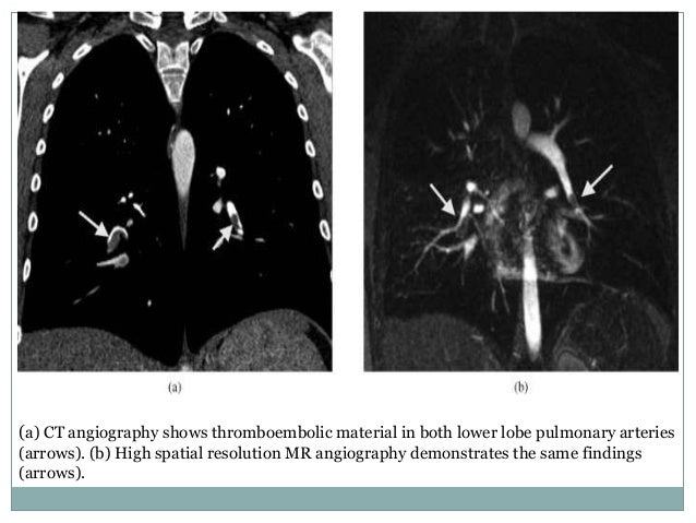 Pulmonary embolism radiology