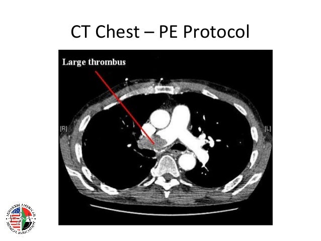 Pulmonary embolism