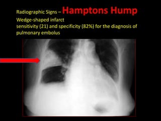 Pulmonary embolism 2 | PPTX