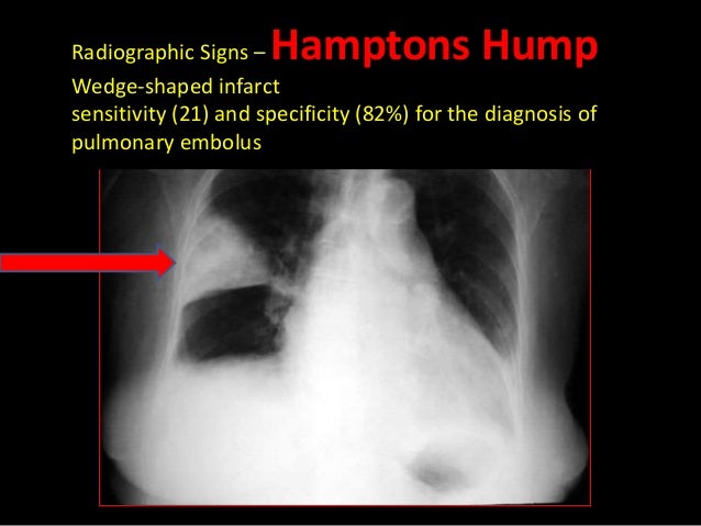 Pulmonary embolism 2