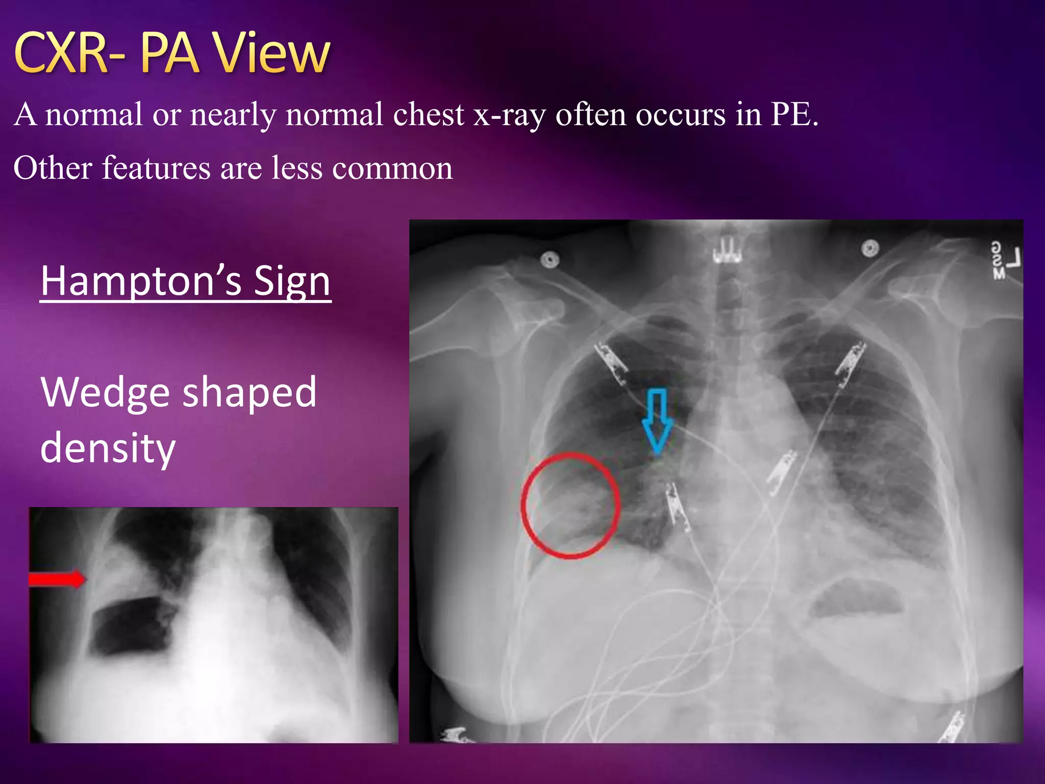 Pulmonary embolism 21jan21 | PPT