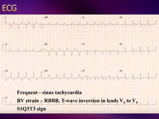 Pulmonary embolism 21jan21 | PPT