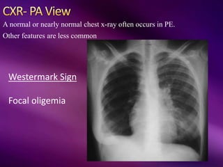 Pulmonary embolism 21jan21 | PPT