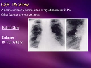 Pulmonary embolism 21jan21 | PPT