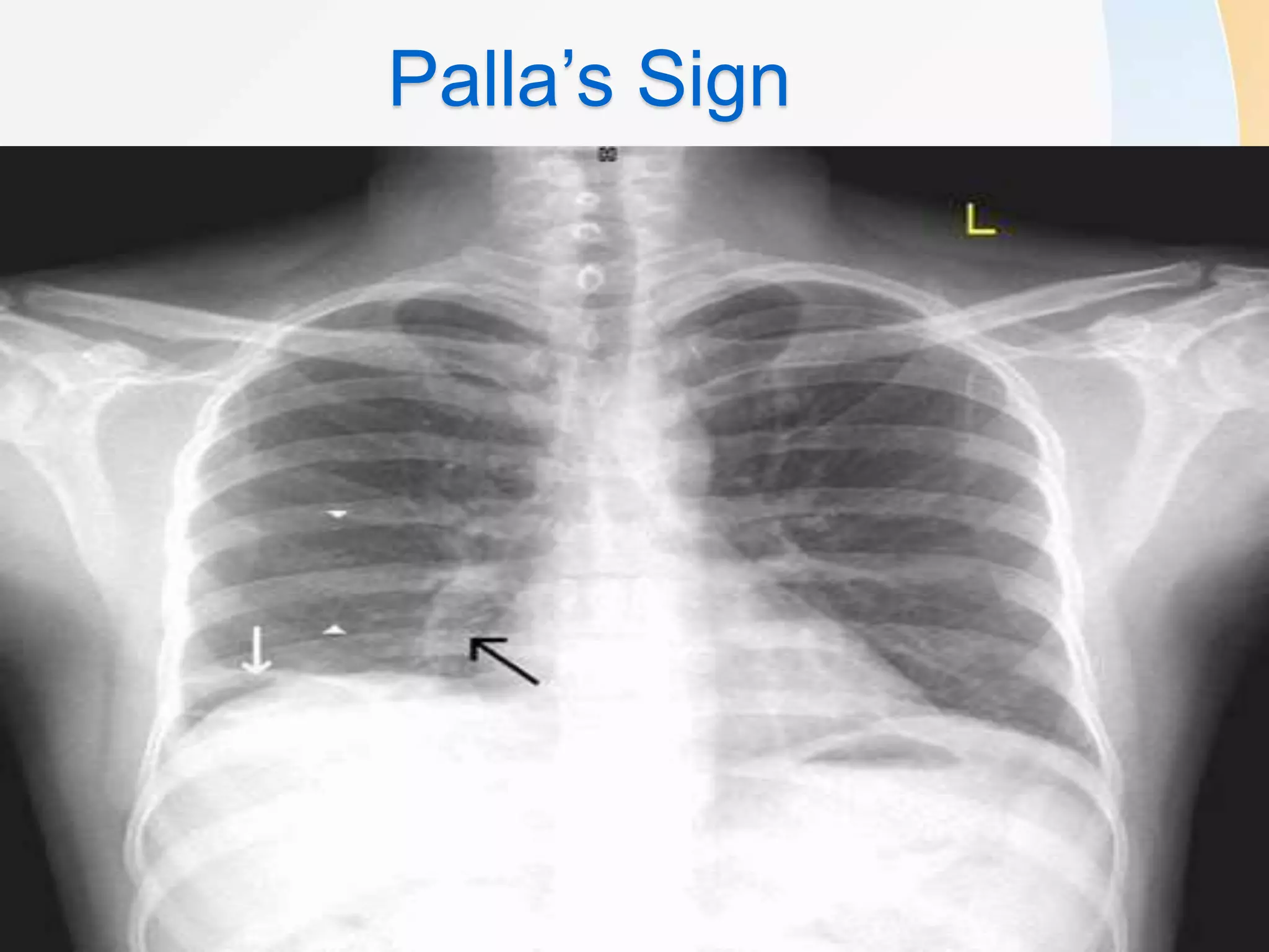 Pulmonary Embolism | PPTX