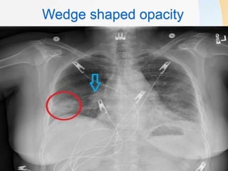 Pulmonary Embolism | PPTX