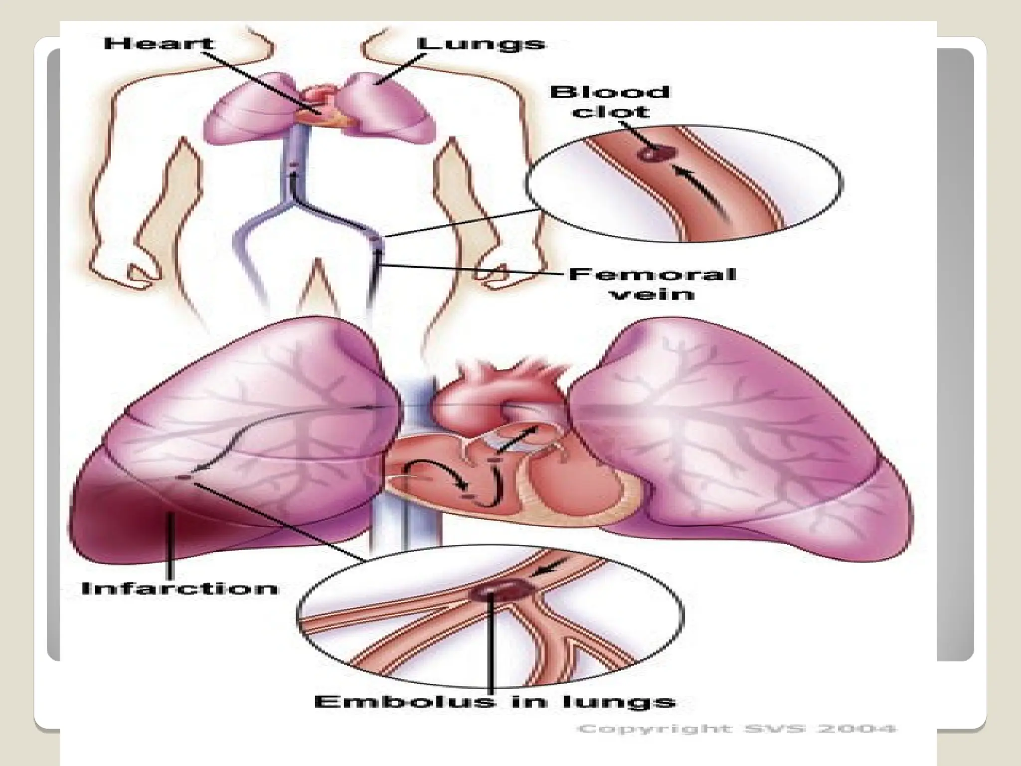 pulmonary embolism by Dr.Raafat AL-Awadhi.pptx