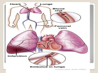 pulmonary embolism by Dr.Raafat AL-Awadhi.pptx | Free Download