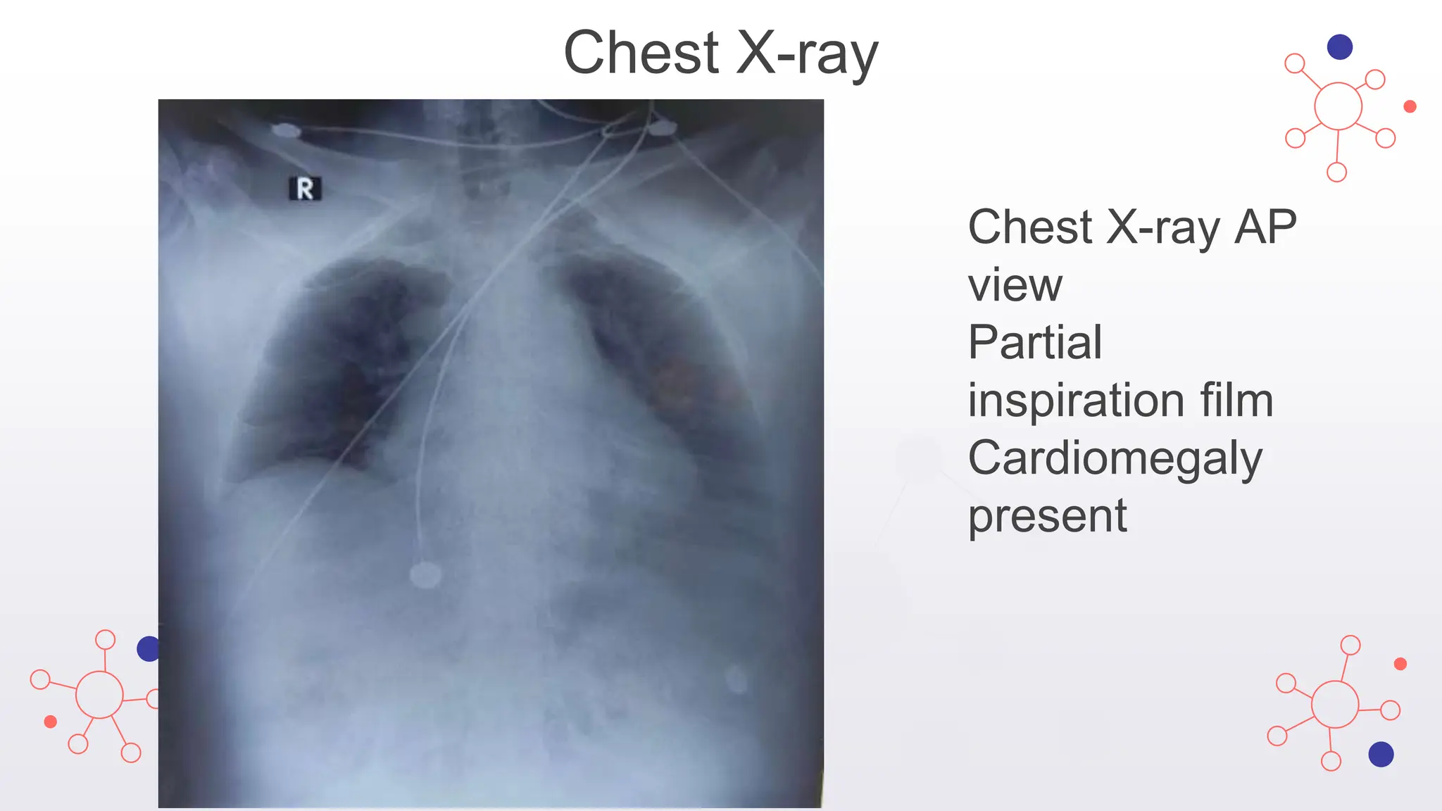 Pulmonary Embolism case presentation (1).pptx
