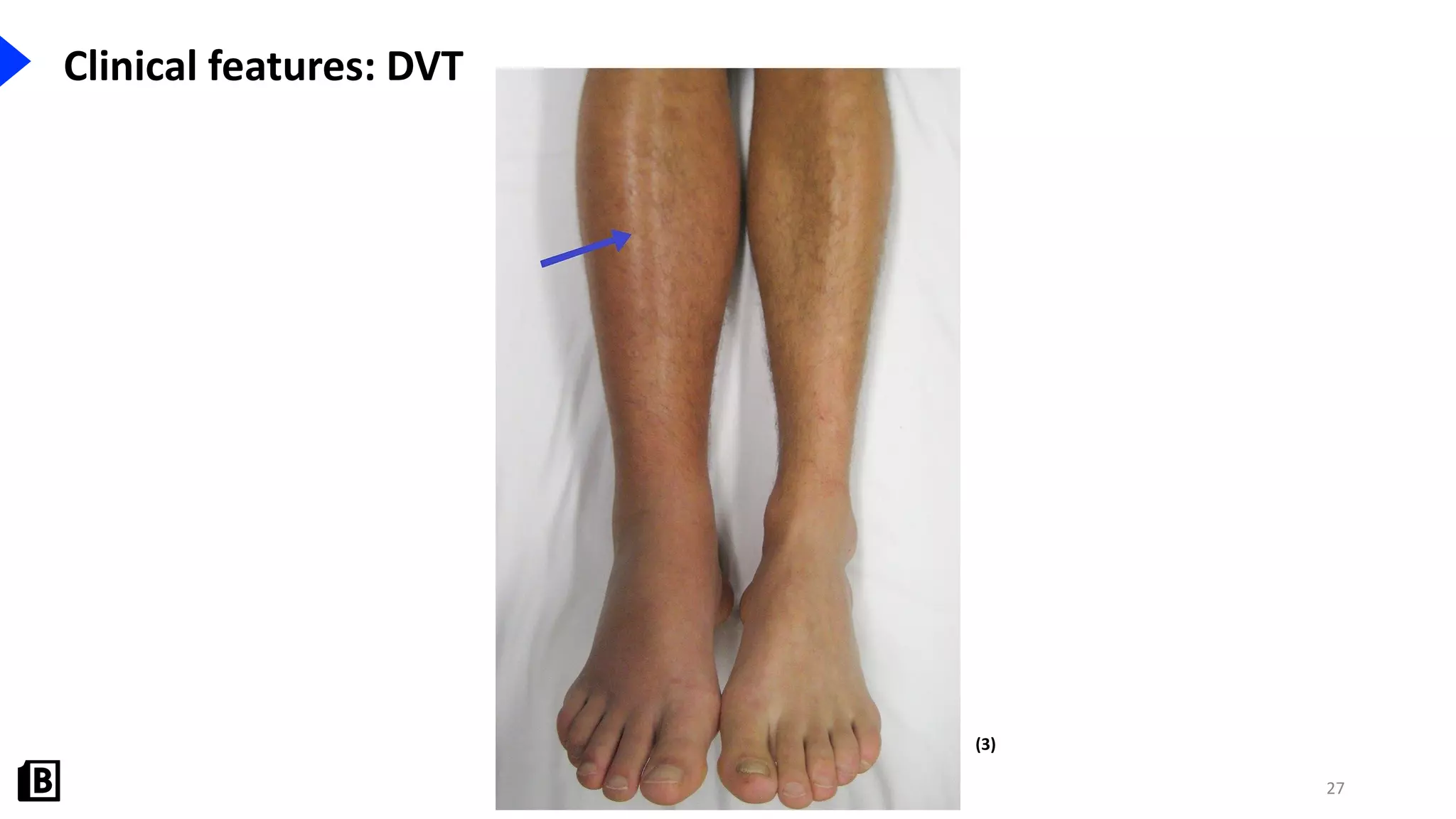 Pulmonary Embolism & Deep Vein Thrombosis - Handout.pdf