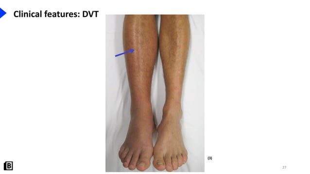Pulmonary Embolism & Deep Vein Thrombosis - Handout.pdf