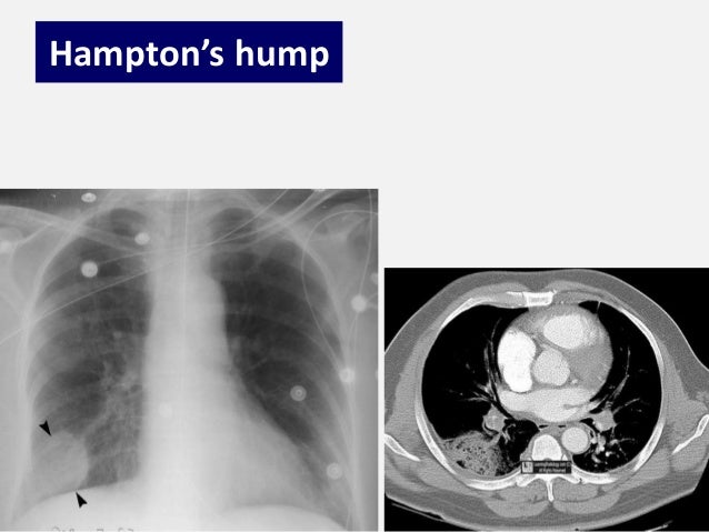 Pulmonary Embolism- Diagnosis by Dr.Tinku Joseph