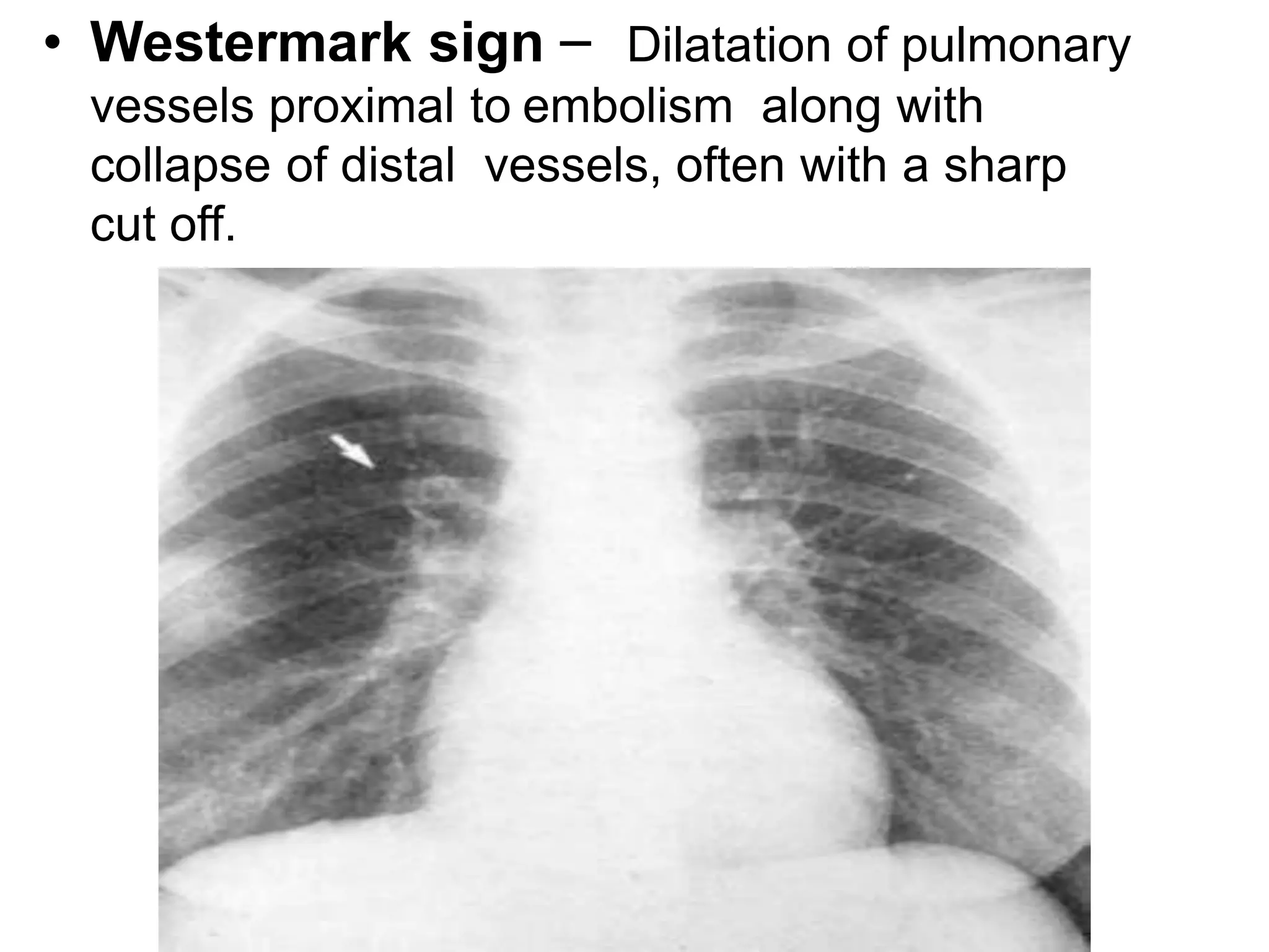Pulmonary embolism radiology imaging | PPTX