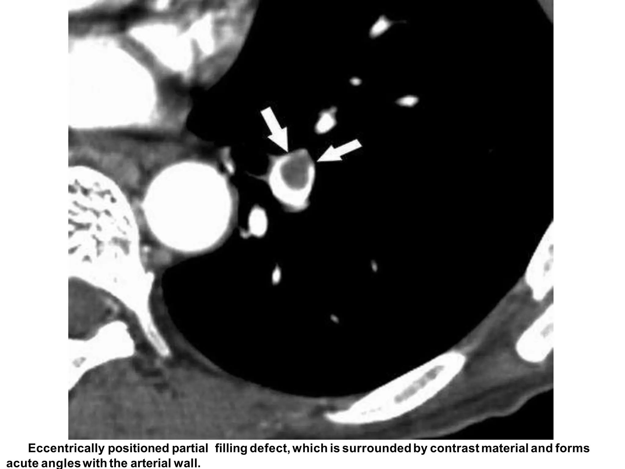 Pulmonary embolism radiology imaging | PPTX