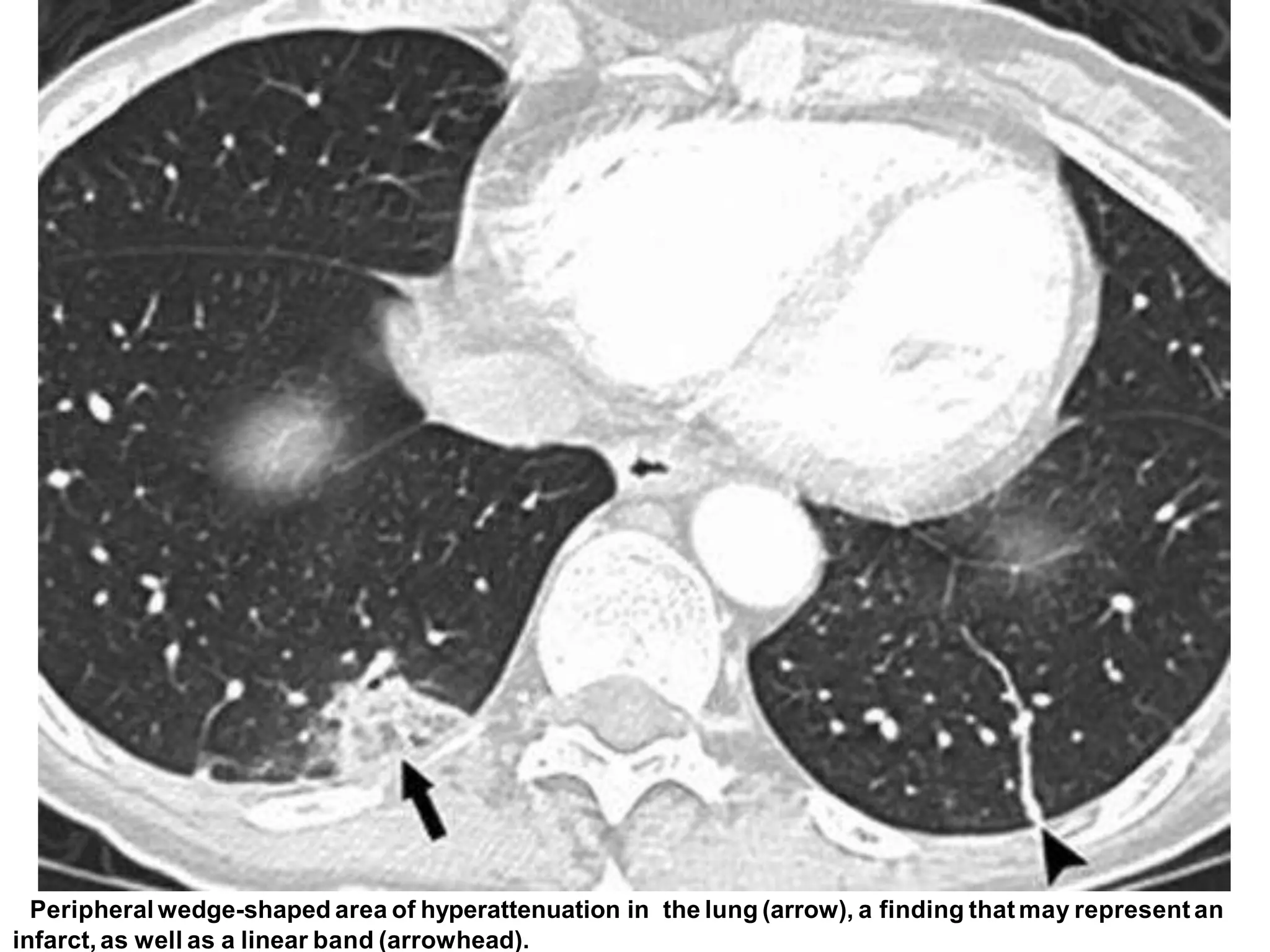 Pulmonary embolism radiology imaging | PPTX