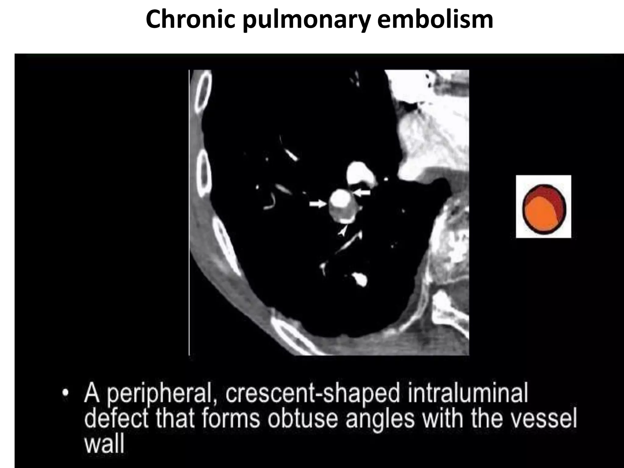 Pulmonary embolism radiology imaging | PPTX | Lung and Respiratory ...