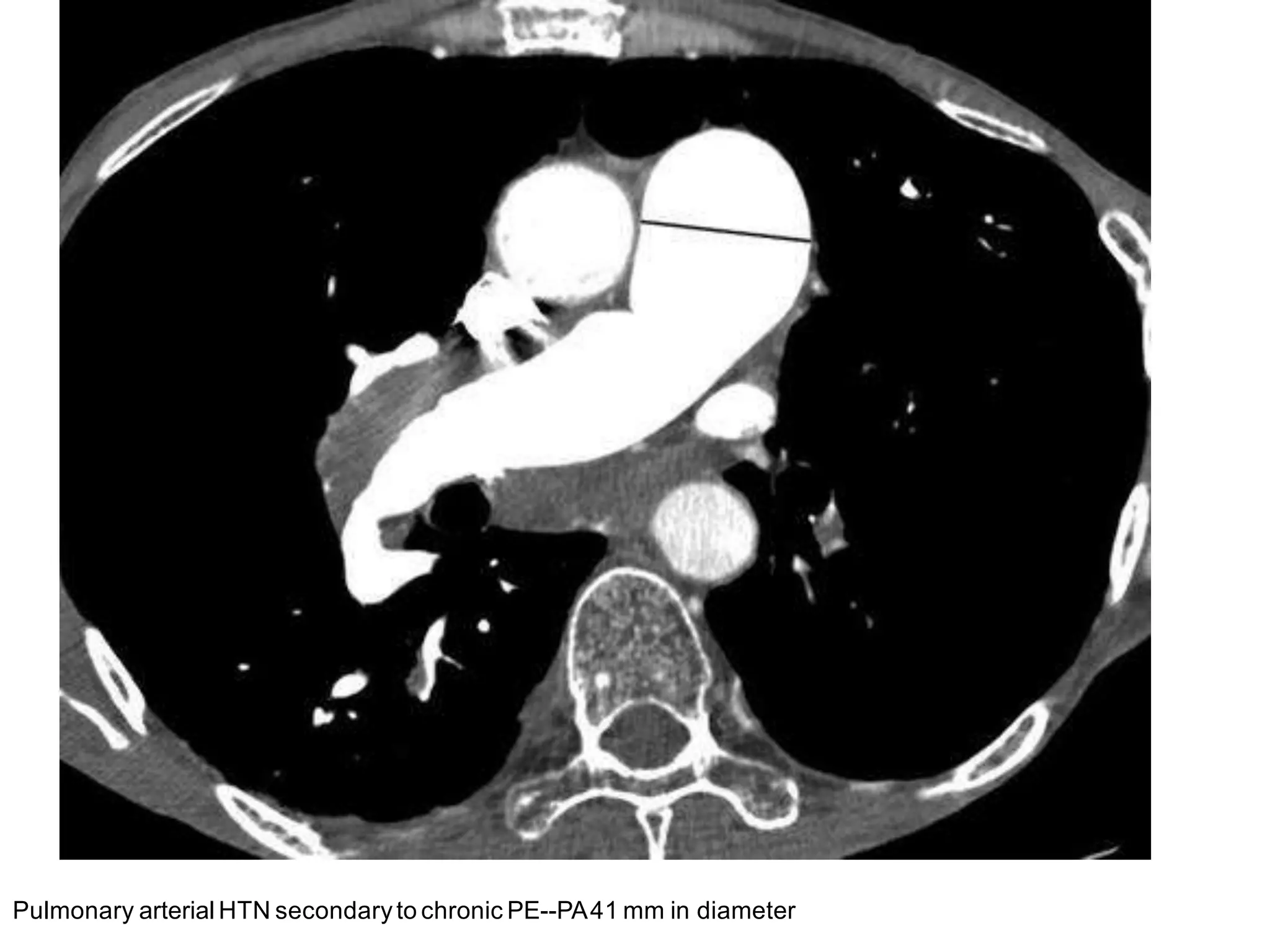 Pulmonary embolism radiology imaging | PPTX