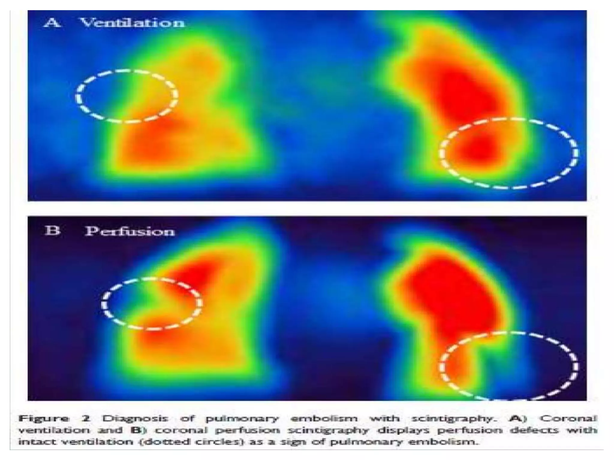 Pulmonary embolism radiology imaging | PPTX