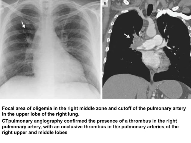 Pulmonary embolism radiology imaging | PPTX | Lung and Respiratory ...