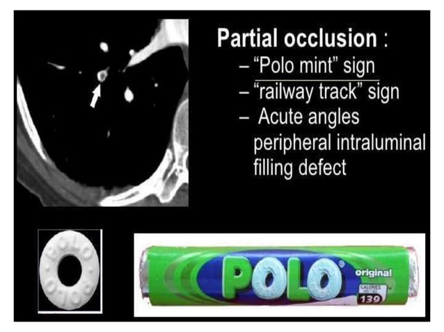 Pulmonary embolism radiology imaging | PPTX | Lung and Respiratory ...