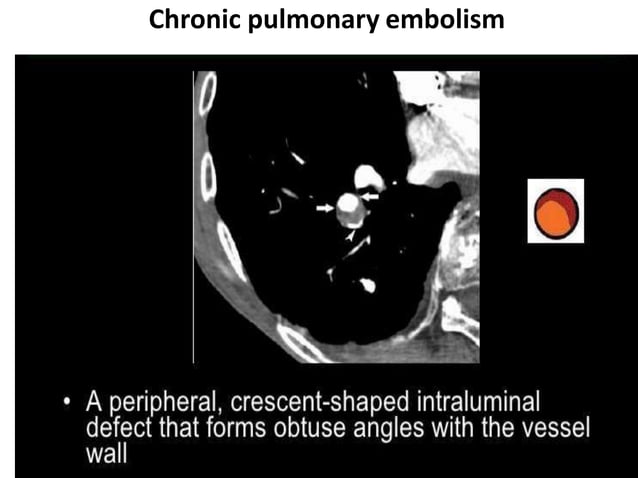 Pulmonary embolism radiology imaging | PPTX | Lung and Respiratory ...