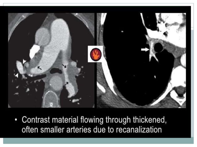 Pulmonary embolism radiology imaging | PPTX | Lung and Respiratory ...
