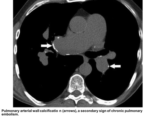 Pulmonary embolism radiology imaging | PPTX | Lung and Respiratory ...