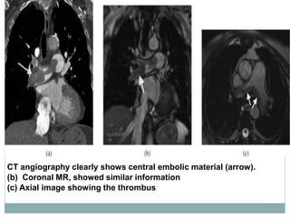 Pulmonary embolism radiology imaging | PPTX