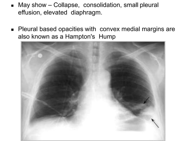 Pulmonary embolism radiology imaging