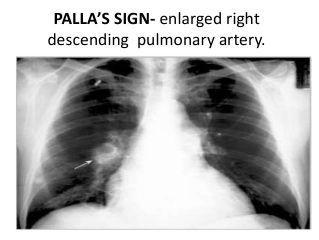 Pulmonary embolism radiology imaging
