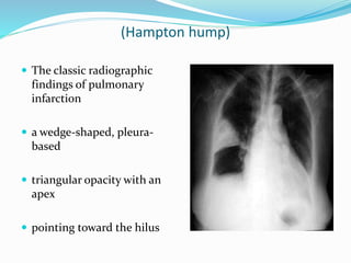 Pulmonary embolism | PPTX
