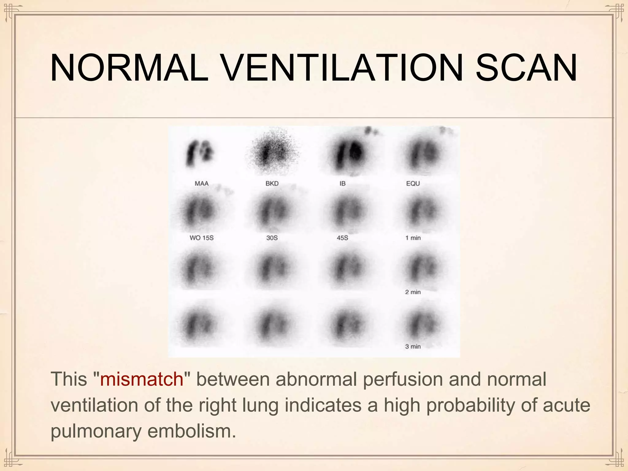 Pulmonary embolism investigations | PPTX