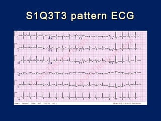Pulmonary embolism managenent | PPT