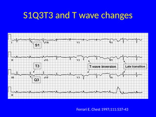 Pulmonary Embolism ppt which is beneficial for pg | PPTX
