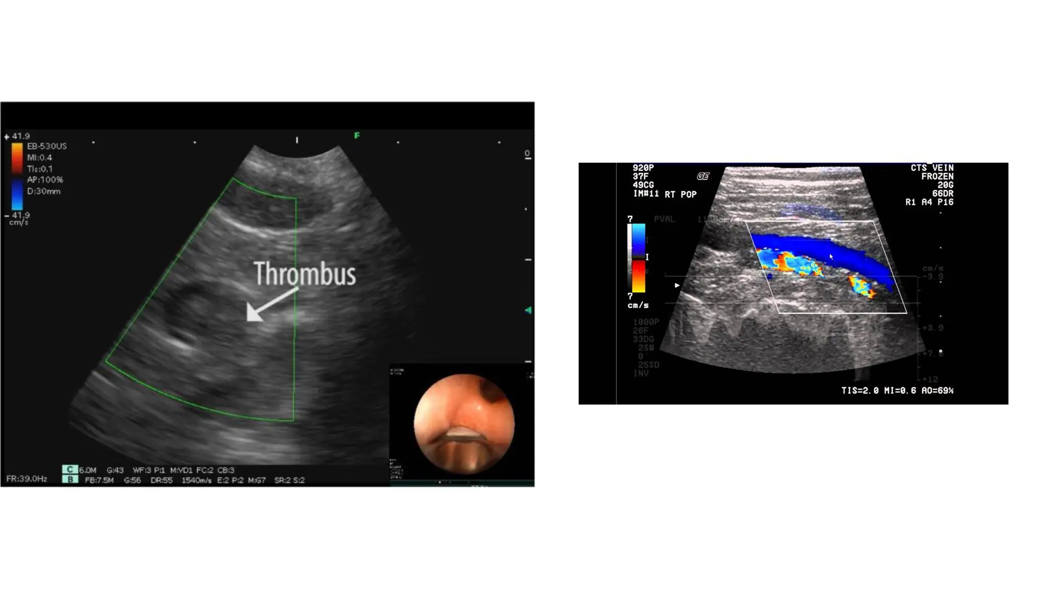 Pulmonary Embolisms Pdf Including Causes Diagnosis Treatment Ppt