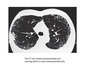 Pulmonary fibrosis | PDF