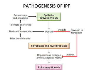 Idiopathic Pulmonary Fibrosis Pathogenesis