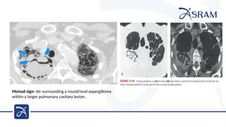 Pulmonary fungal infections.pptx lung dixeXe | PPTX