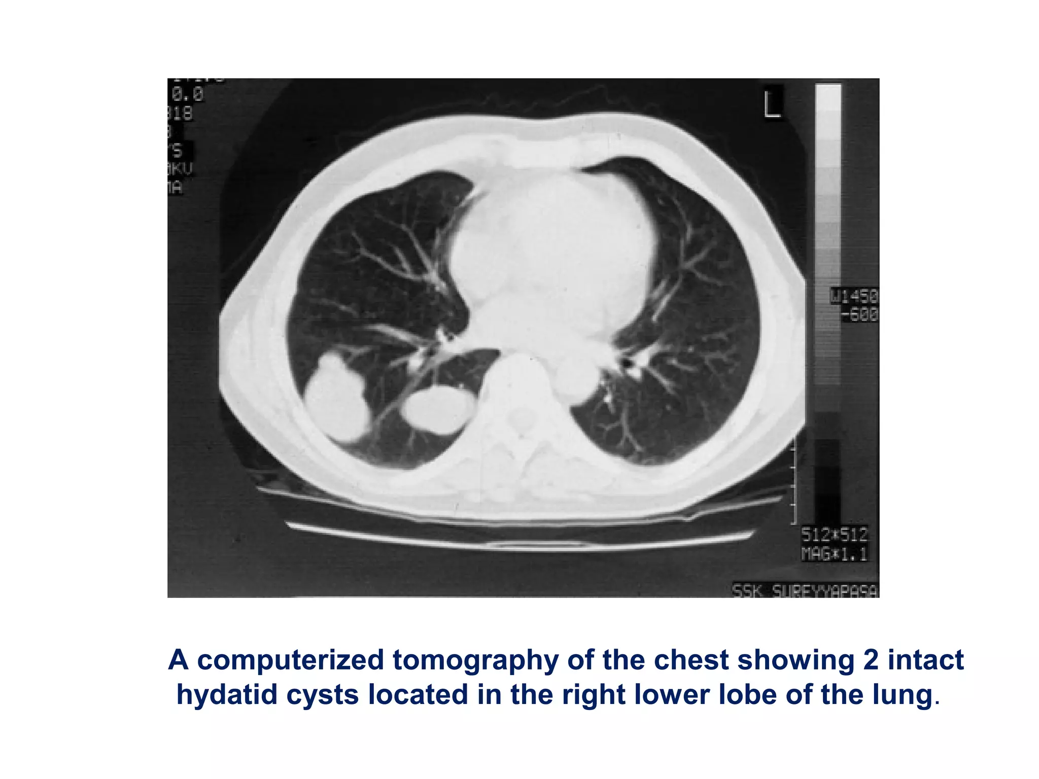 Pulmonary hydatid cysts | PPT