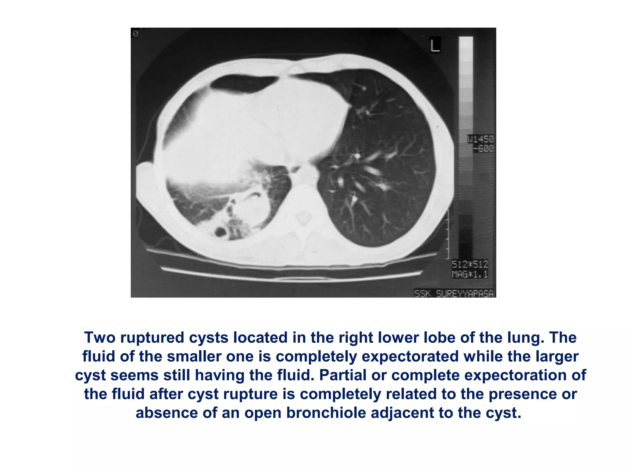 Pulmonary hydatid cysts | PPT