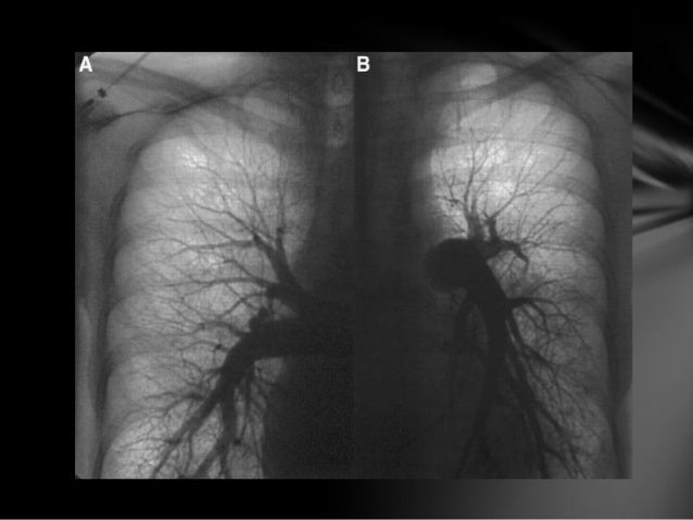 Pulmonary hypertension
