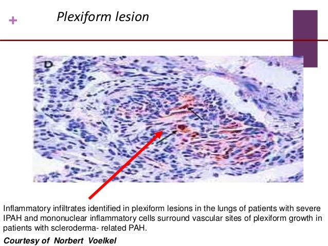 Pulmonary hypertension