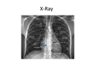 Radiology of Pulmonary Hypertension | PPTX