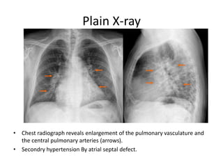 Pulmonary Artery X Ray