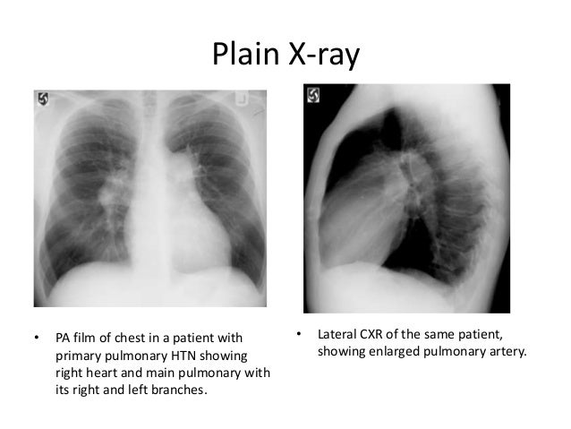 Radiology of Pulmonary Hypertension