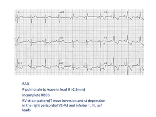 Pulmonary hypertension | PPTX